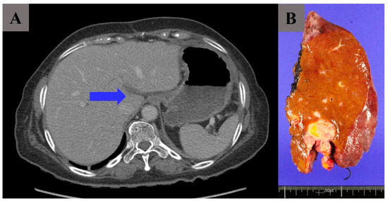 Cancers | Free Full-Text | Left Hemi-Hepatectomy to Resect Metastatic ...