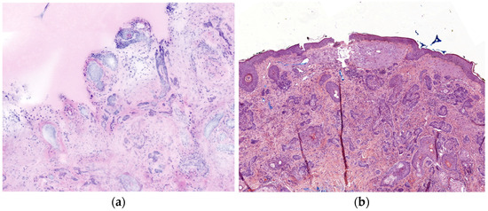 Ex Vivo Confocal Microscopy Speeds up Surgical Margin Control of Re ...