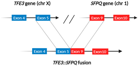 TFE3-Rearranged Tumors of the Kidney: An Emerging Conundrum