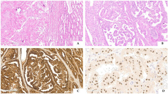 TFE3-Rearranged Tumors of the Kidney: An Emerging Conundrum