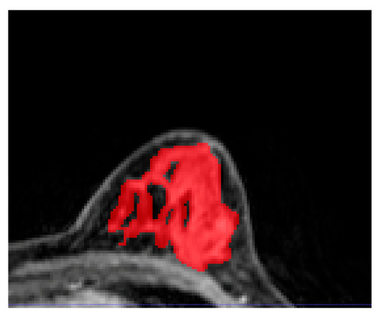 Development of an MRI Radiomic Machine-Learning Model to Predict Triple ...