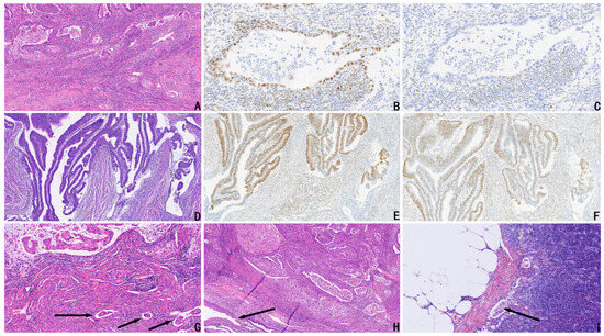 Analysis of Clinicopathological and Molecular Features of Microcystic ...