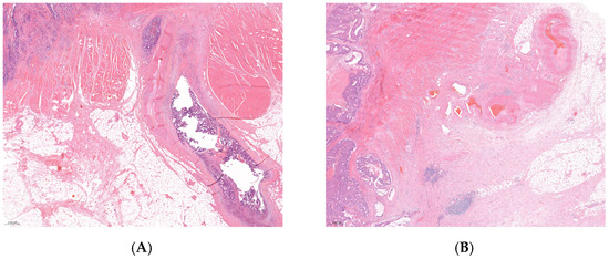 Prognostic Value of Separate Extramural Vascular Invasion Reporting in ...