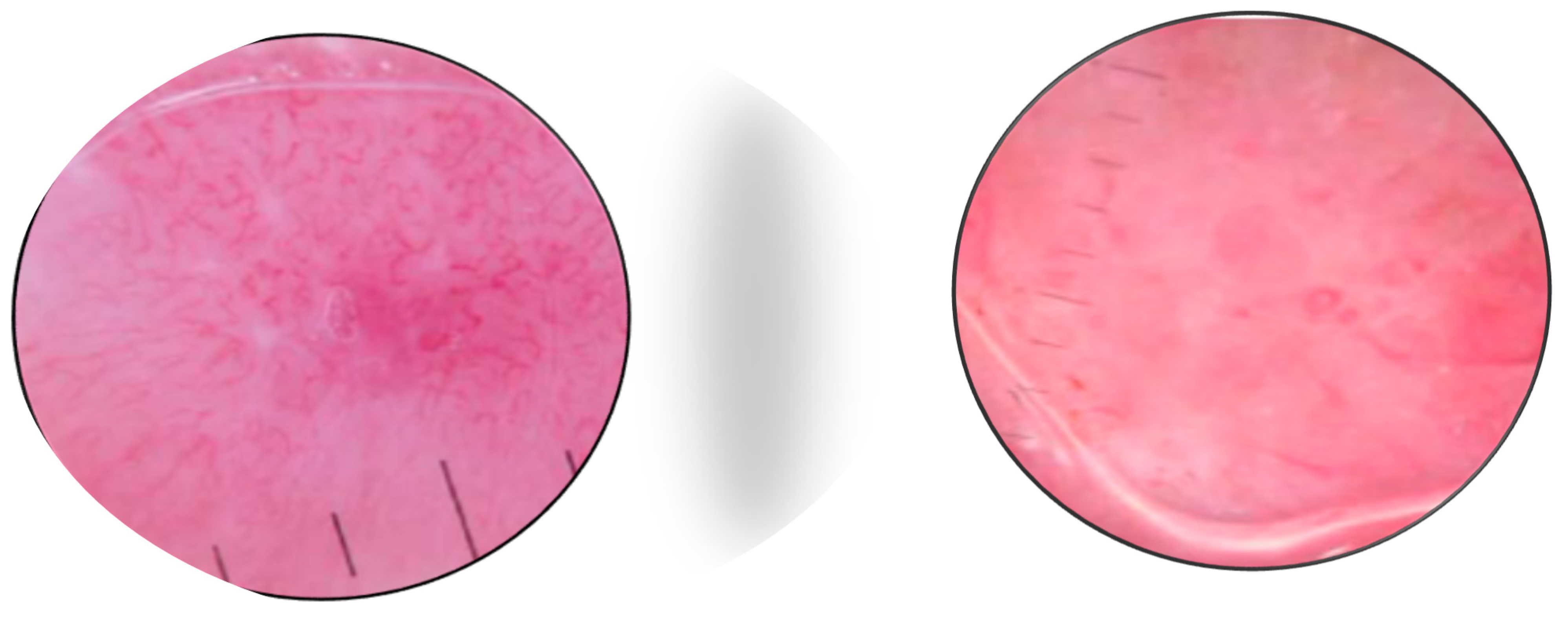 A Review of Non-Invasive Skin Imaging in Merkel Cell Carcinoma ...