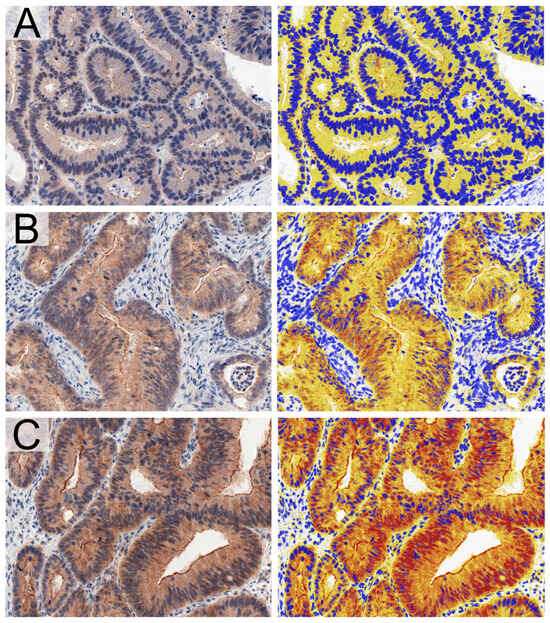 TYK2 Protein Expression and Its Potential as a Tissue-Based Biomarker for the Diagnosis of ...