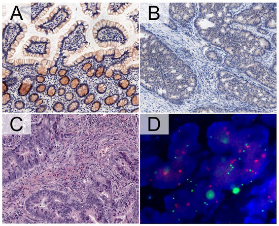 TYK2 Protein Expression and Its Potential as a Tissue-Based Biomarker for the Diagnosis of ...