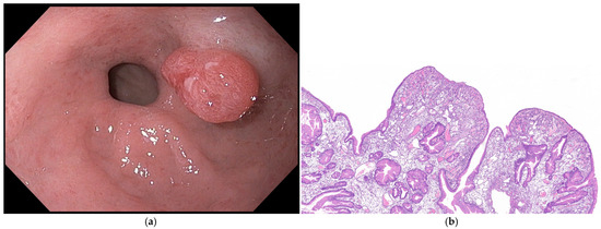 Gastric Epithelial Polyps: Current Diagnosis, Management, and ...