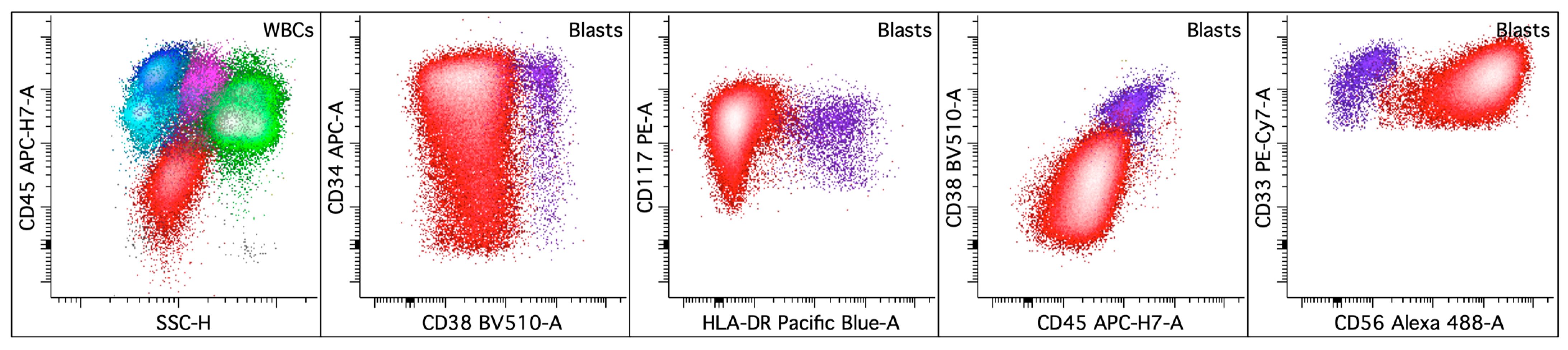 Acute Myeloid Leukemia: Diagnosis and Evaluation by Flow Cytometry