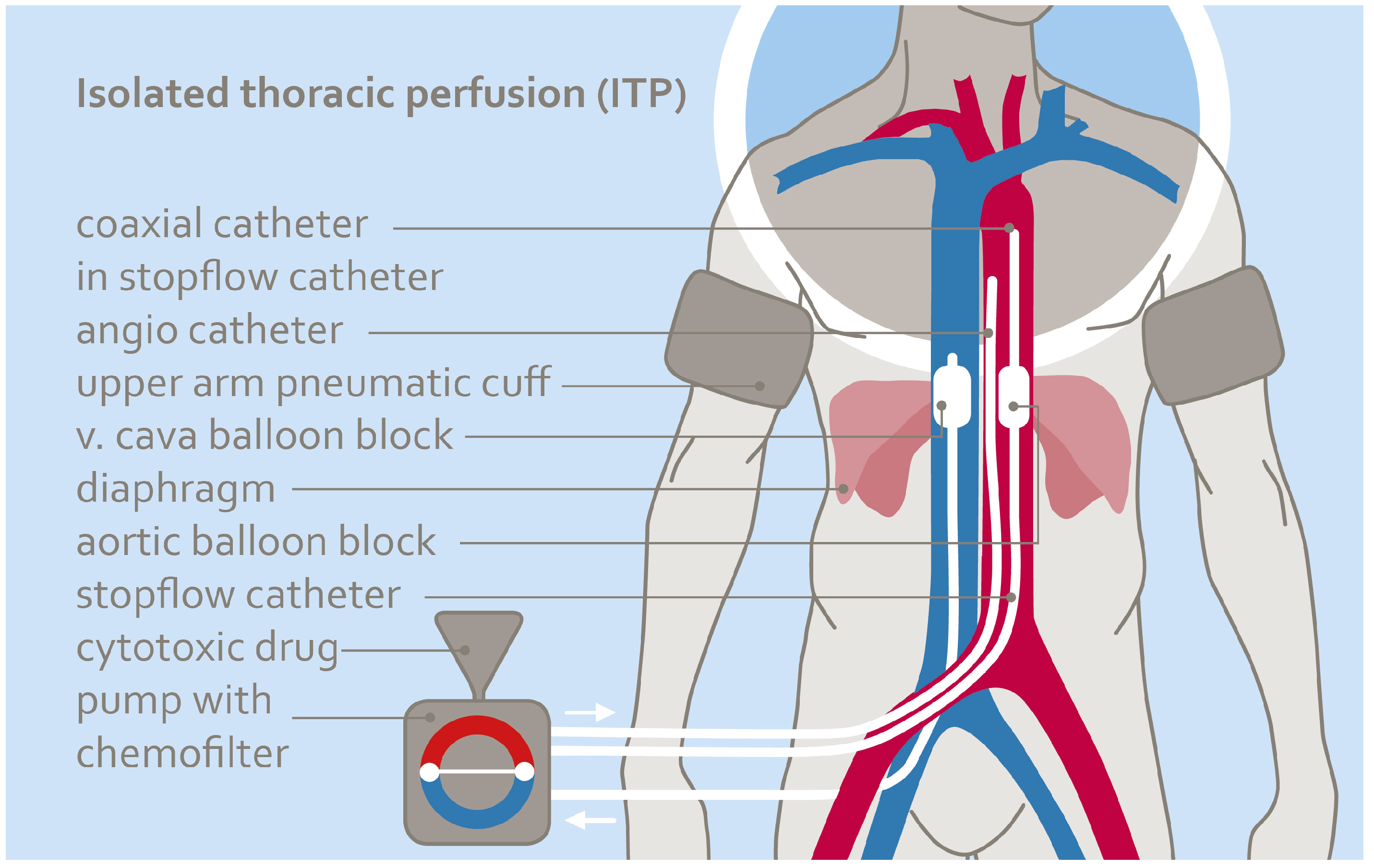 Arterial Infusion and Isolated Perfusion in Combination with Reversible ...