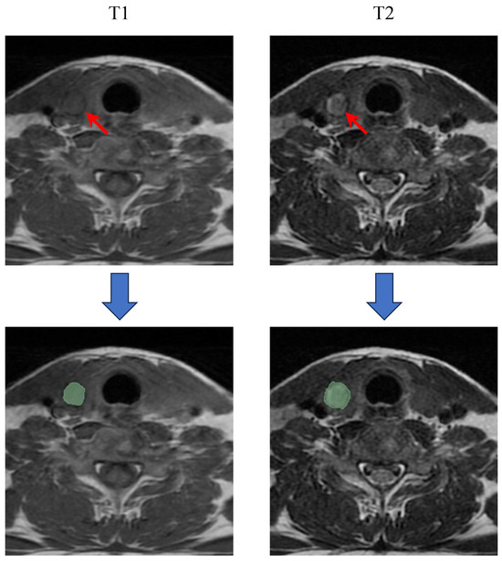Multimodal MRI Deep Learning for Predicting Central Lymph Node ...
