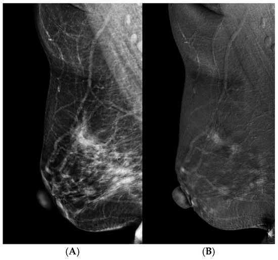 Contrast-Enhanced Mammography: A Literature Review of Clinical Uses for ...