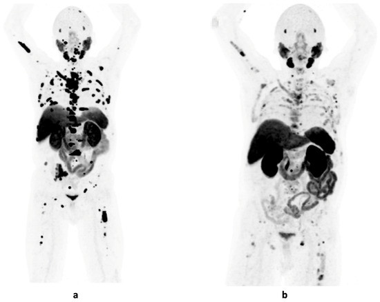 Current Clinical Applications of PSMA-PET for Prostate Cancer Diagnosis ...