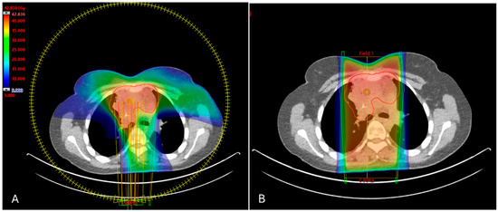 Minimizing Long-Term Toxicities for Patients with Primary Mediastinal B ...