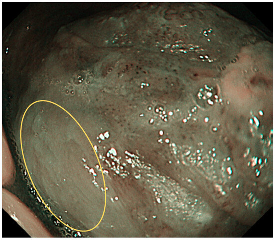 Prospects for Narrow Band Imaging Magnification Endoscopy in Oral ...
