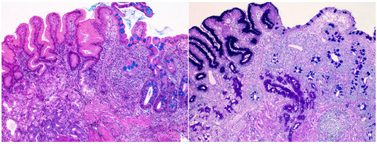 Gastric Intestinal Metaplasia in Children and Adolescents Is Reversible ...