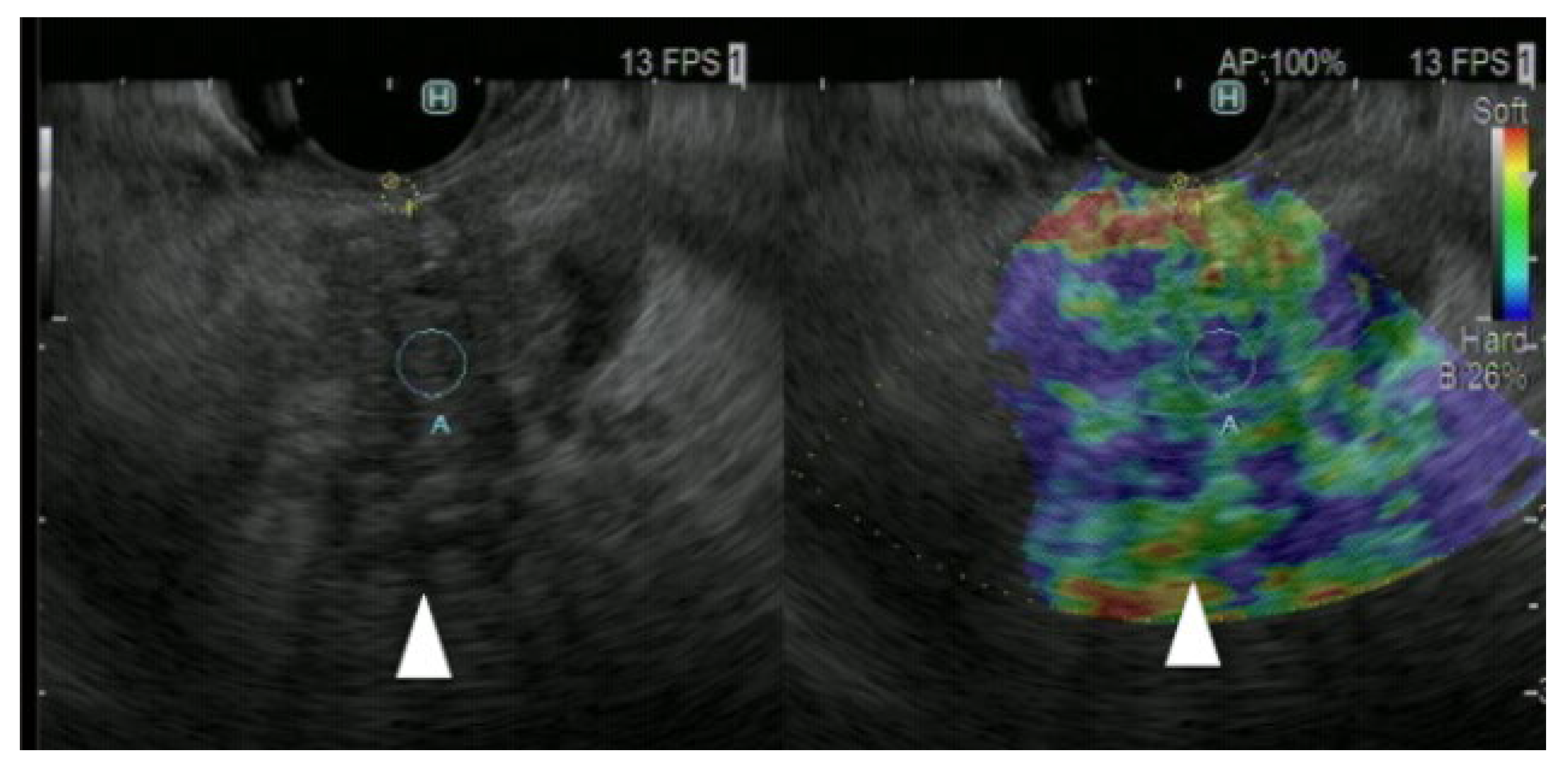 Advances in Endoscopic Ultrasonography-Based Diagnosis of Pancreatic ...
