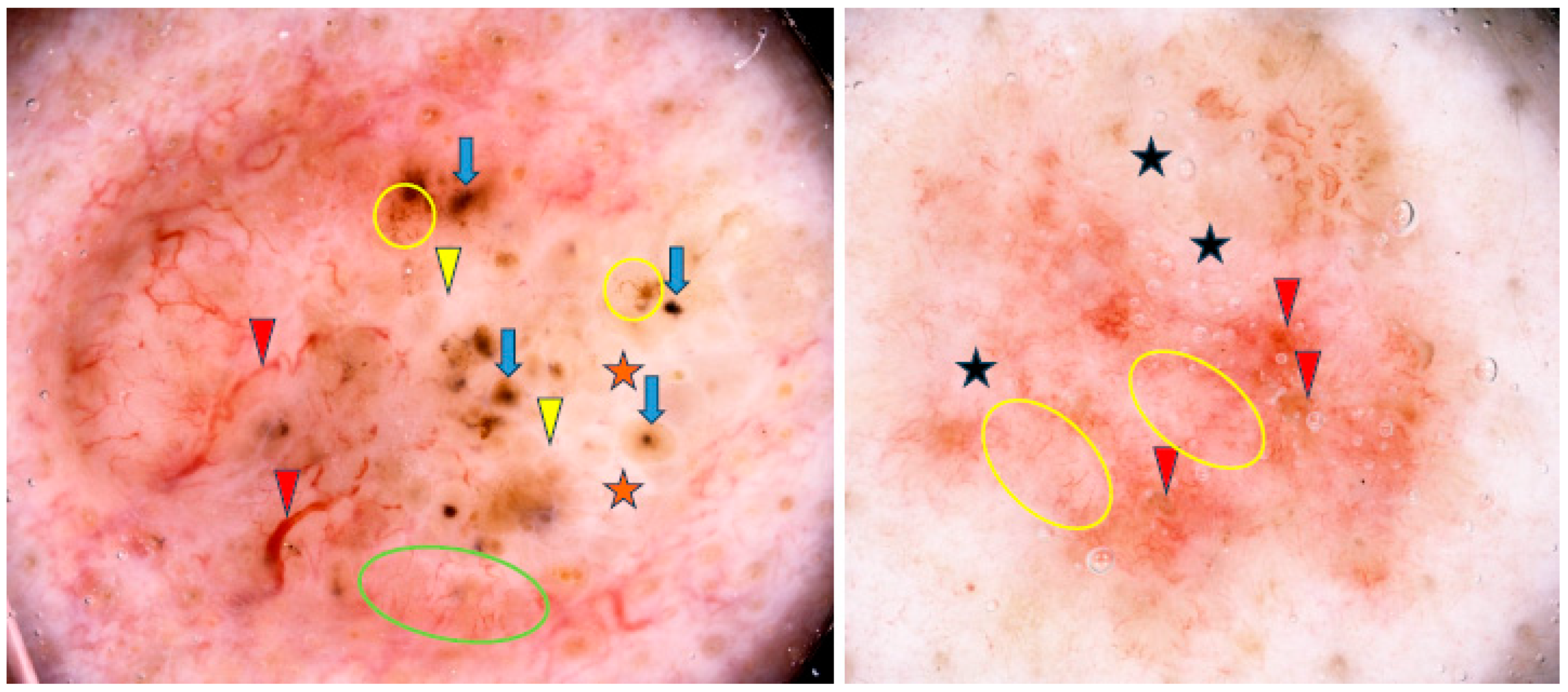 Dermoscopy of Basal Cell Carcinoma Part 2: Dermoscopic Findings by Lesion Subtype, Location, Age ...