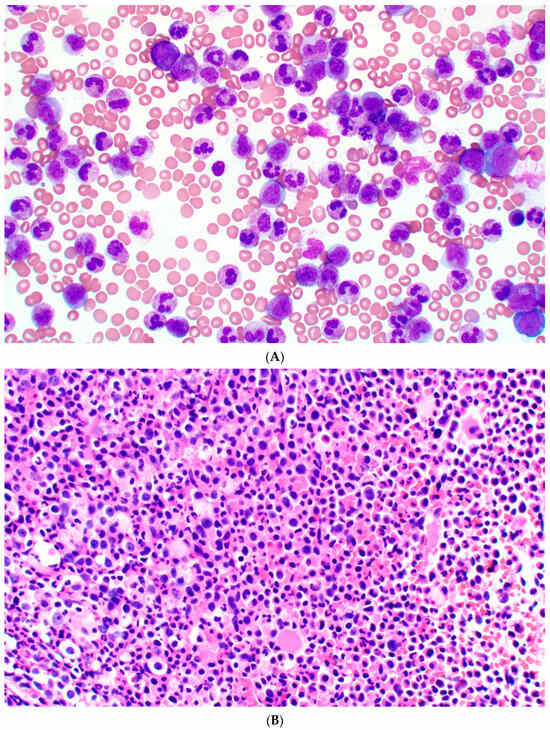 Chronic Neutrophilic Leukemia: Advances in Diagnosis, Genetic Insights, and Management Strategies