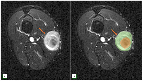Imaging of Peripheral Intraneural Tumors: A Comprehensive Review for ...