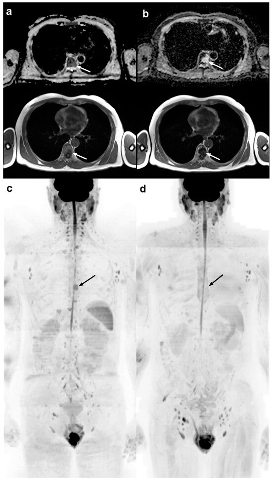 The Whole-Body MRI Reporting and Data System Guidelines for Prostate ...