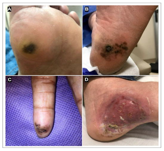 Acral Melanoma in Skin of Color: Current Insights and Future Directions ...