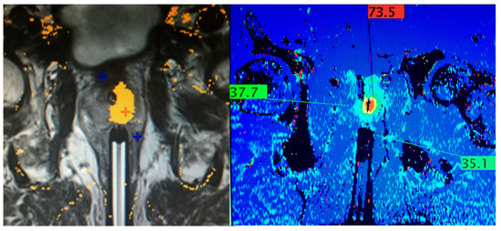 Anatomic and Clinical Effects of Focal Laser Ablation of the Prostate ...