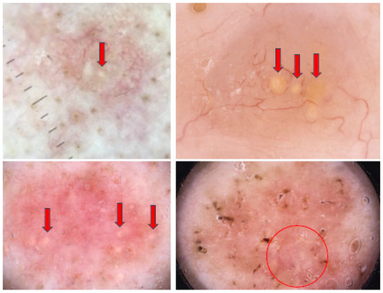 Dermoscopy of Basal Cell Carcinoma Part 1: Dermoscopic Findings and ...