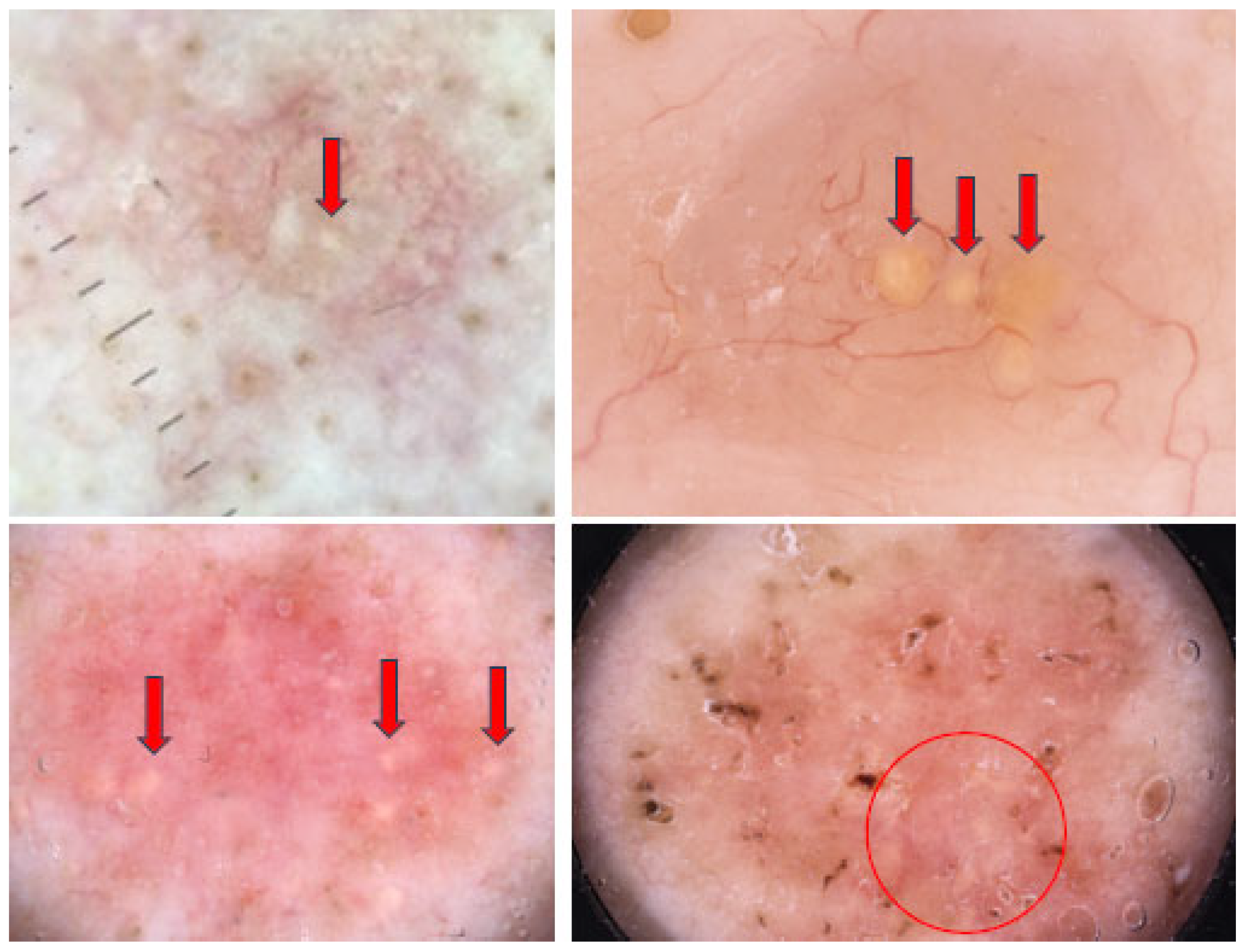 Dermoscopy of Basal Cell Carcinoma Part 1: Dermoscopic Findings and ...