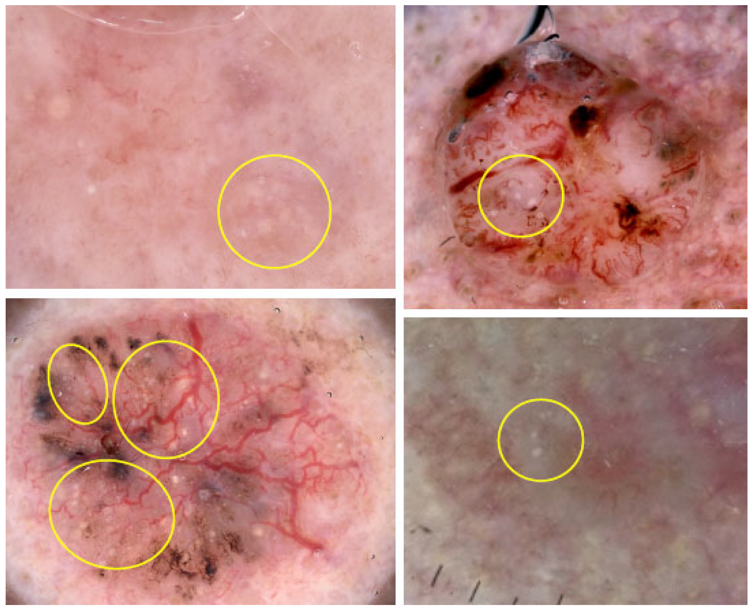 Dermoscopy of Basal Cell Carcinoma Part 1: Dermoscopic Findings and ...