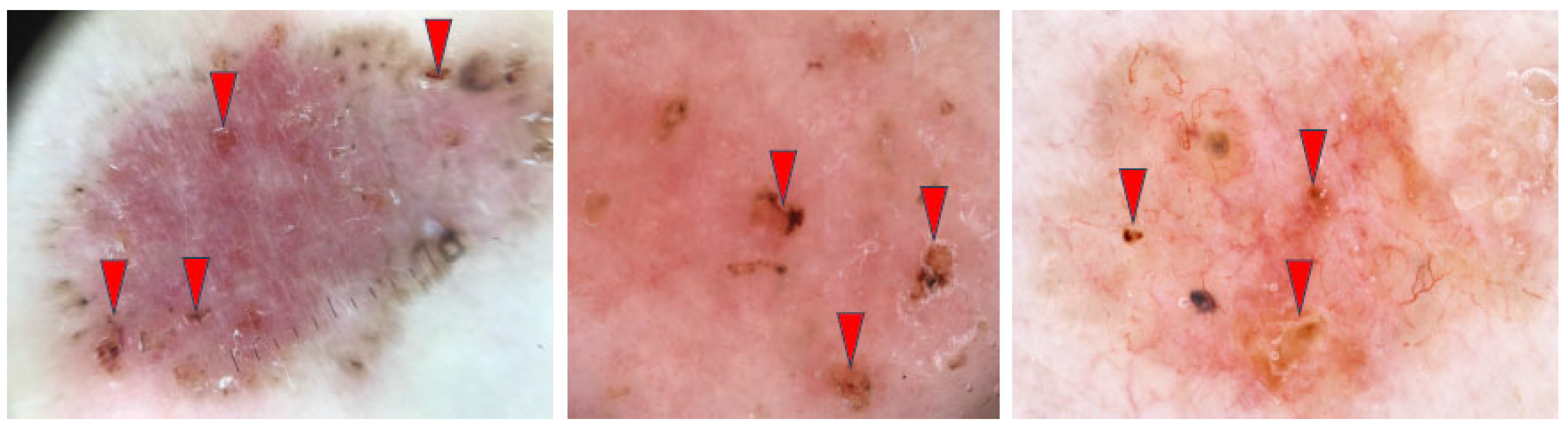 Dermoscopy of Basal Cell Carcinoma Part 1: Dermoscopic Findings and ...