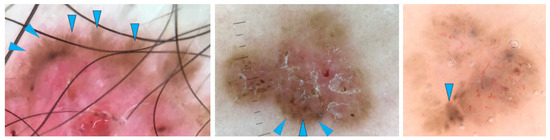 Dermoscopy of Basal Cell Carcinoma Part 1: Dermoscopic Findings and ...