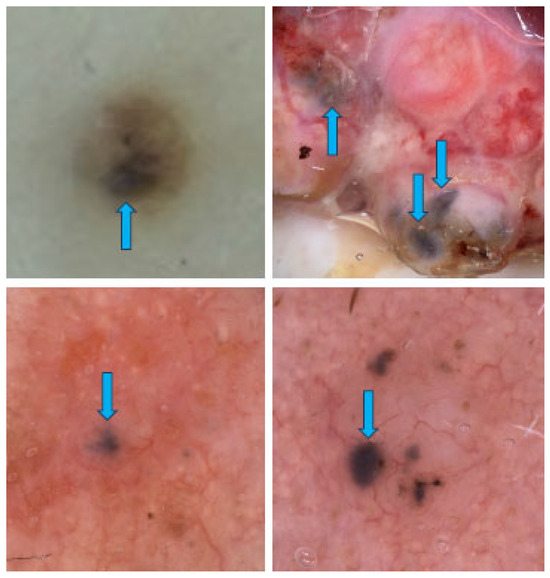 Dermoscopy of Basal Cell Carcinoma Part 1: Dermoscopic Findings and ...