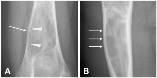 Multimodal Imaging of Osteosarcoma: From First Diagnosis to Radiomics