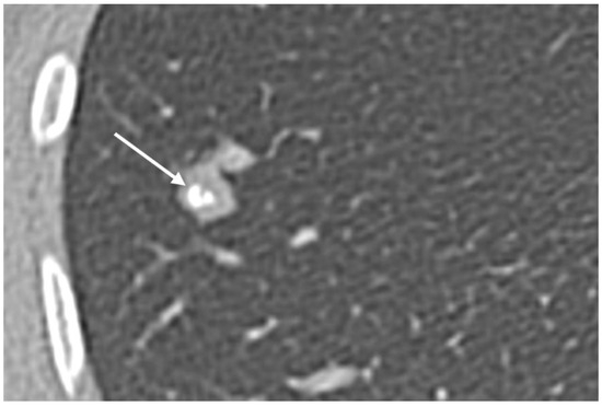 Multimodal Imaging of Osteosarcoma: From First Diagnosis to Radiomics