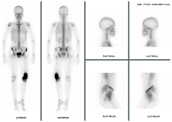 Multimodal Imaging of Osteosarcoma: From First Diagnosis to Radiomics