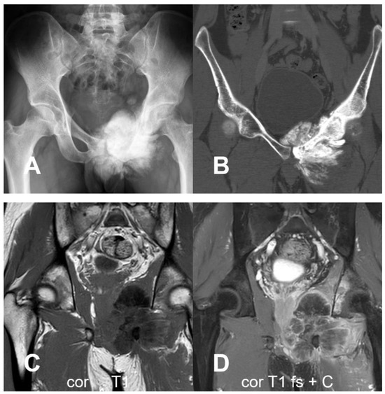 Multimodal Imaging of Osteosarcoma: From First Diagnosis to Radiomics