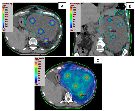 Role of Spatially Fractionated Radiotherapy (LATTICE) Treatment in ...