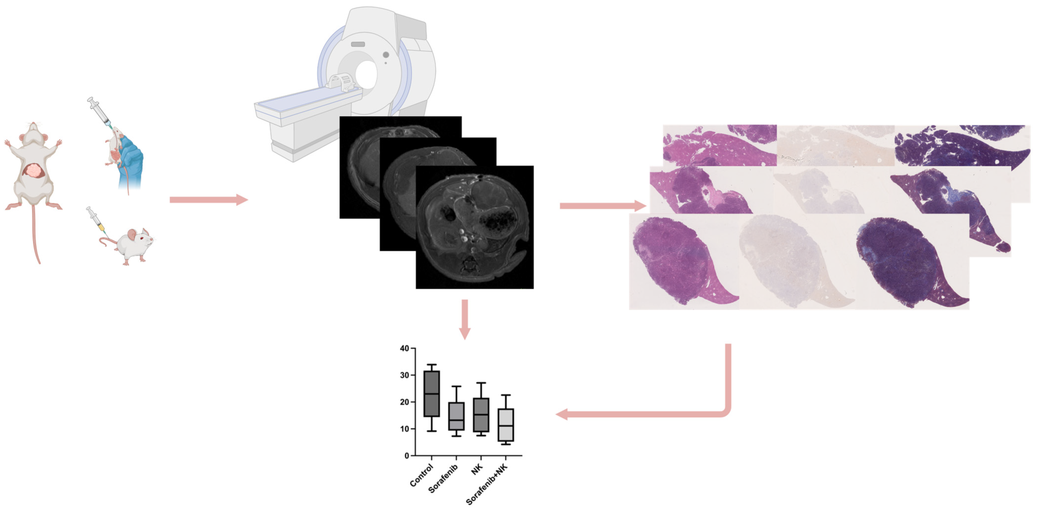 Therapy Combining Sorafenib and Natural Killer Cells for Hepatocellular ...