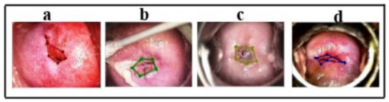 Attention-Enhanced Lightweight Architecture with Hybrid Loss for Colposcopic Image Segmentation
