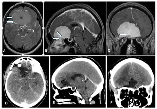 Optimizing Surgical Management of Anterior Skull Base Meningiomas ...