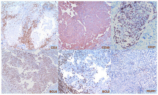 Unveiling Primary Cutaneous B-Cell Lymphomas: New Insights into Diagnosis and Treatment Strategies