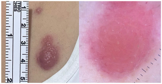 Unveiling Primary Cutaneous B-Cell Lymphomas: New Insights into ...