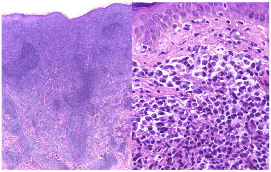 Unveiling Primary Cutaneous B-Cell Lymphomas: New Insights into ...