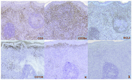 Unveiling Primary Cutaneous B-Cell Lymphomas: New Insights into Diagnosis and Treatment Strategies
