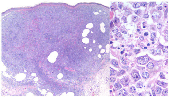 Unveiling Primary Cutaneous B-Cell Lymphomas: New Insights into Diagnosis and Treatment Strategies