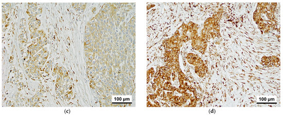 Association Between CKAP4 Expression and Poor Prognosis in Patients ...