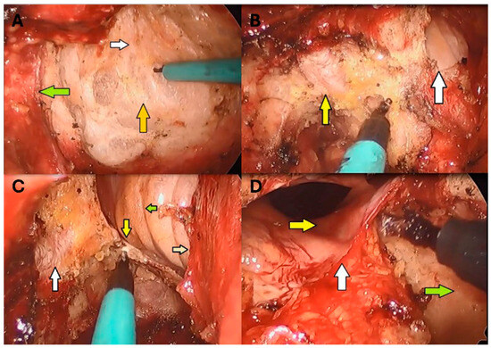 Combined TaTME with SP Robot for Low Anterior Resection in Rectal ...