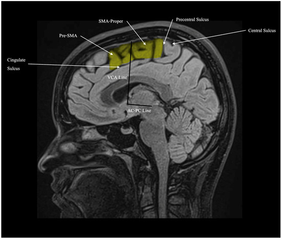 Risk Factors for Neurological Deficits Following Brain Tumor Resection ...