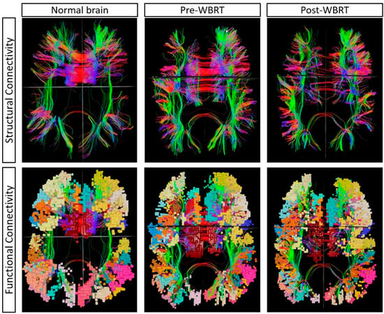 Correlation Between Neurocognitive Outcomes and Neuroaxonal Connectome ...