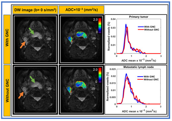 Correction of Gradient Nonlinearity Bias in Apparent Diffusion ...